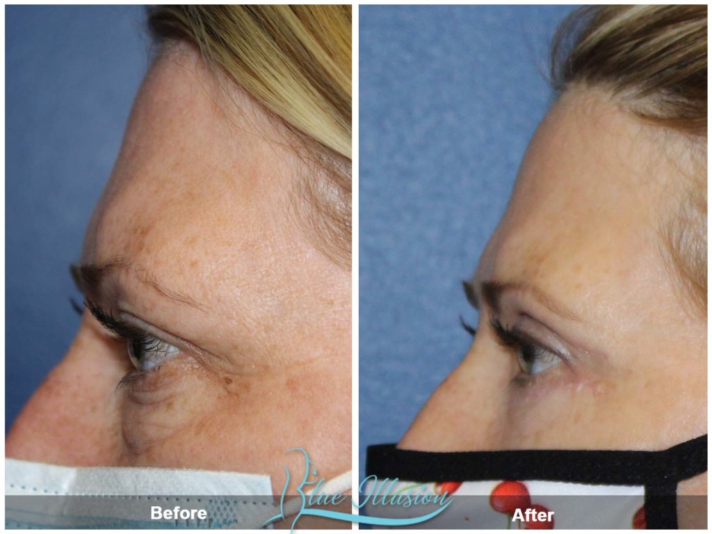 Before & After Gallery | Otoplasty San Diego, CA | Eyelid Surgery Chula ...