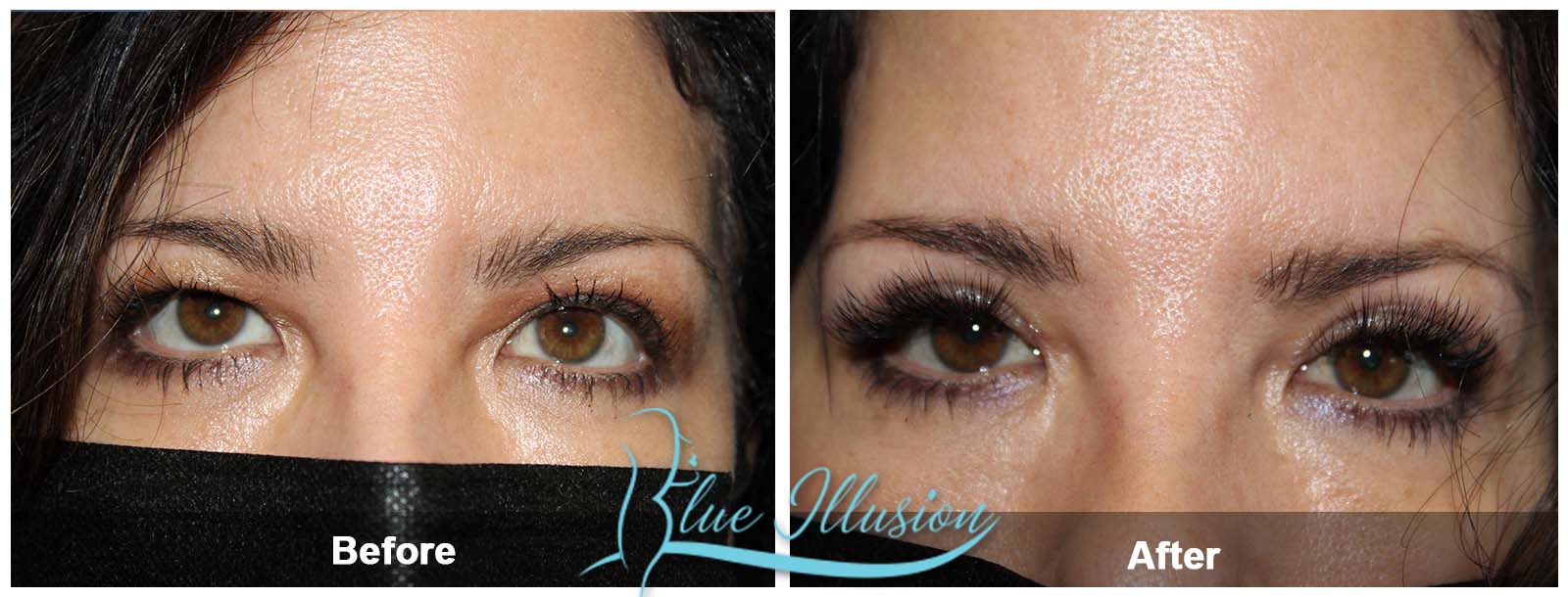 Before & After Gallery | Otoplasty San Diego, CA | Eyelid Surgery Chula ...
