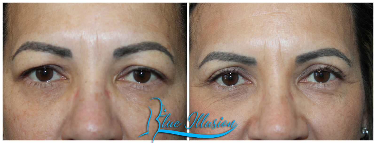 Before & After Gallery | Otoplasty San Diego, CA | Eyelid Surgery Chula ...