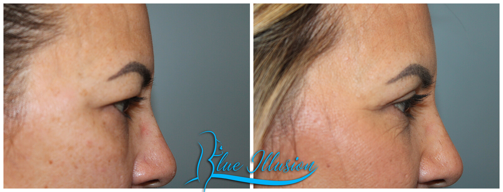 Before & After Gallery | Otoplasty San Diego, CA | Eyelid Surgery Chula ...